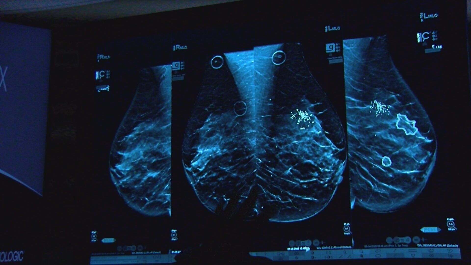 Aspirus Rhinelander upgrades 3D mammography machine to detect breast ...