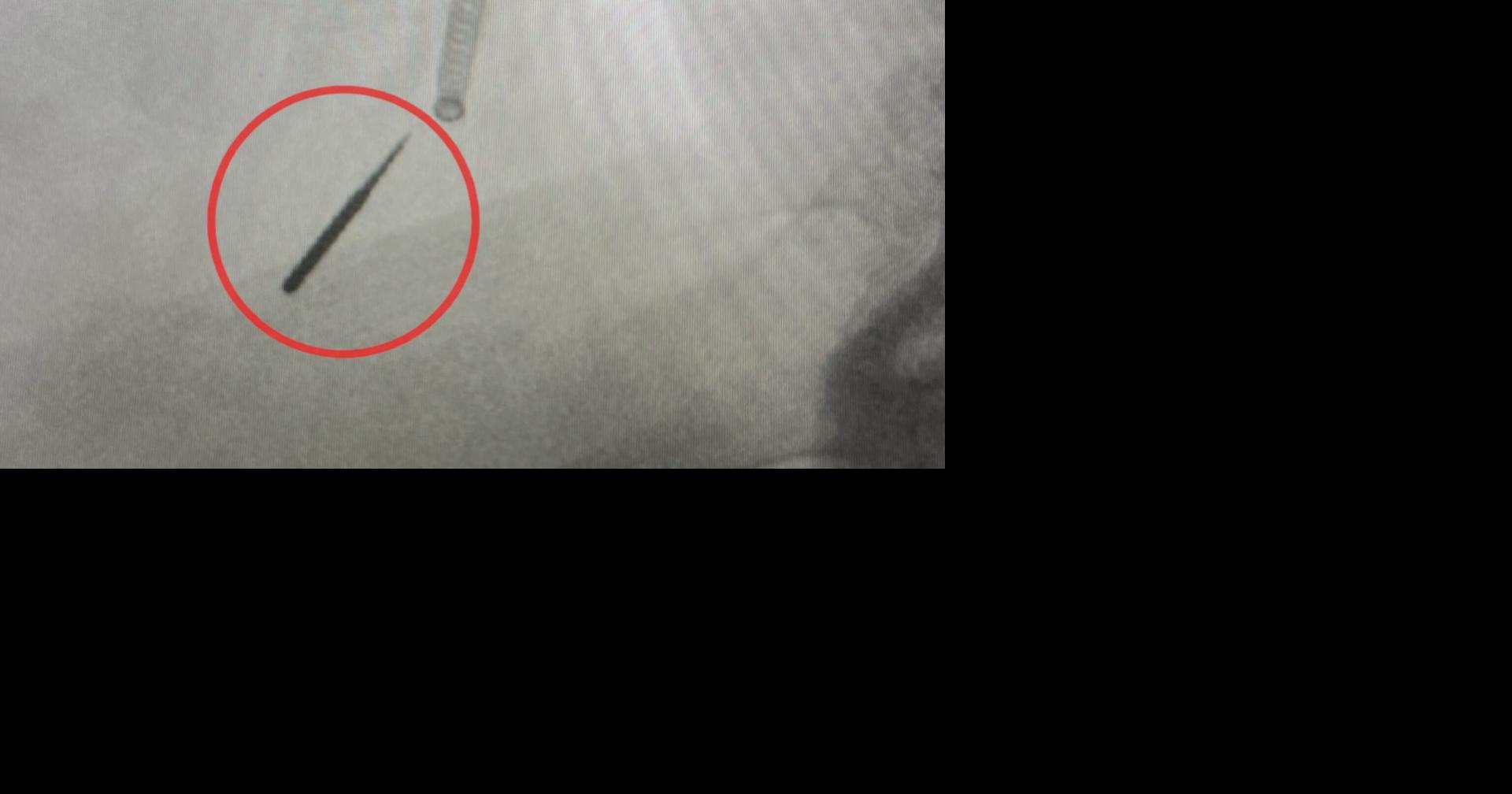 Dental drill bit removed from man's lung | News | wkow.com
