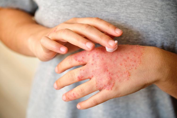 dry hands rash