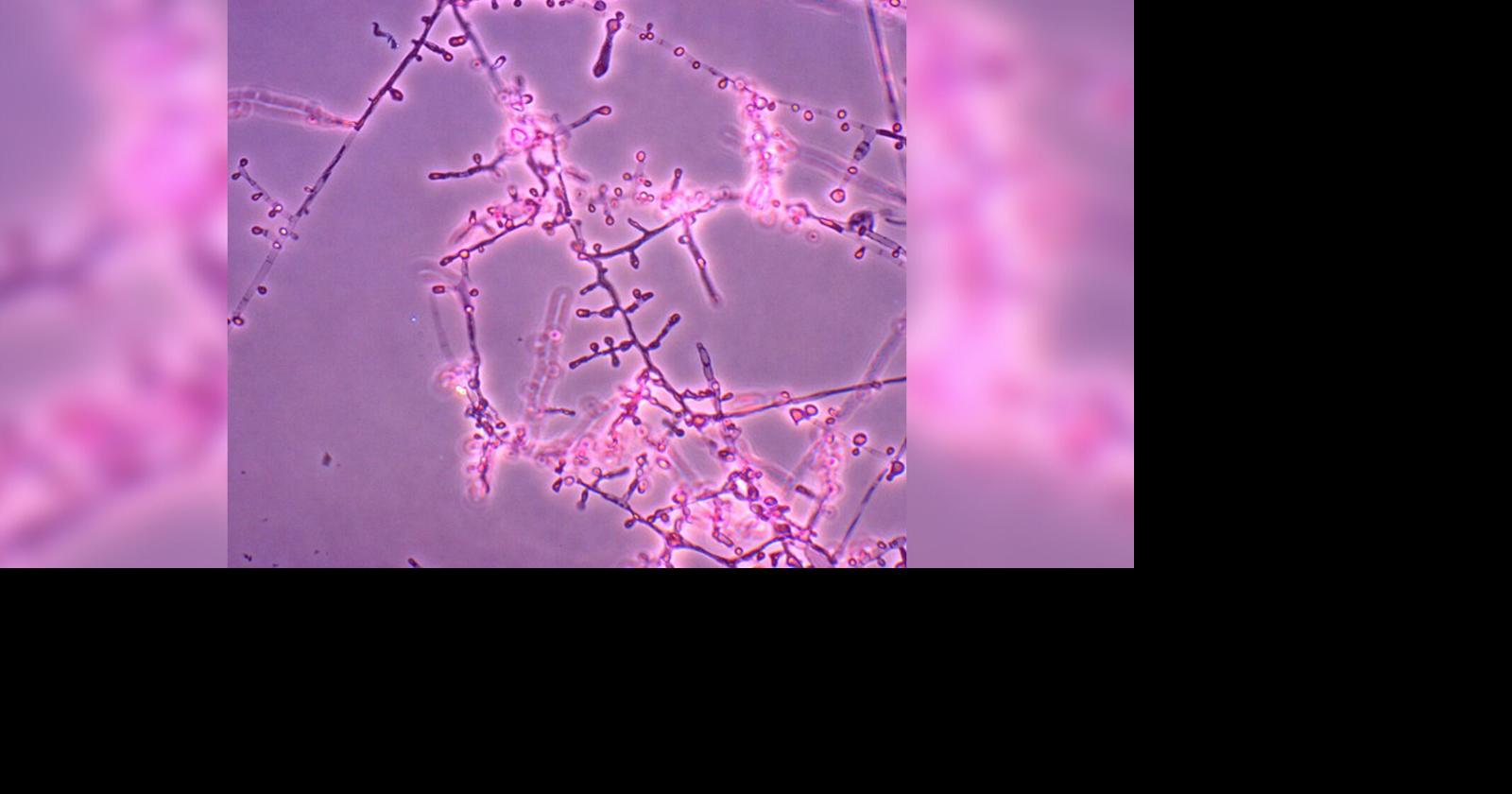 First US cases of treatment-resistant ringworm found in patients in New ...