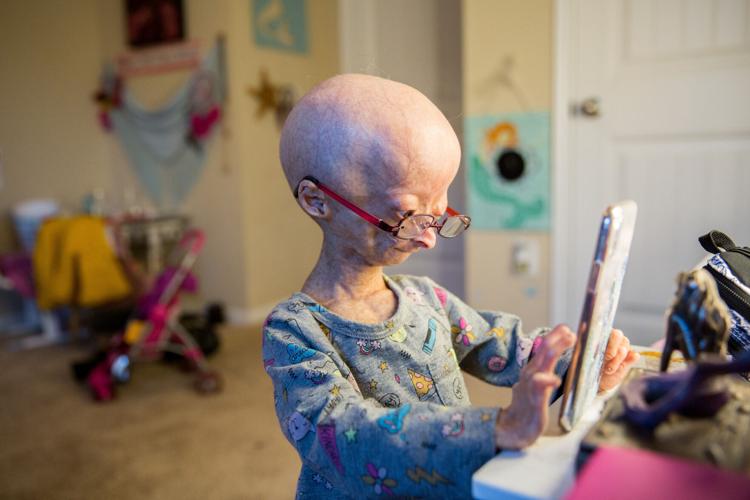 rose progeria