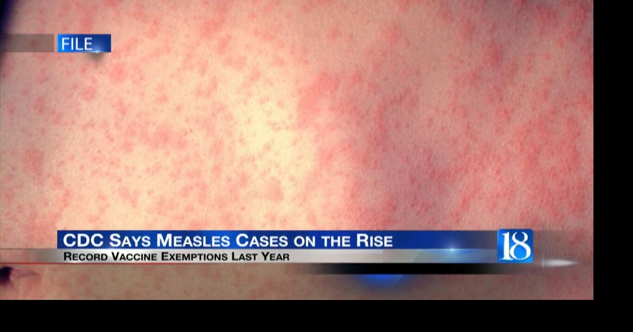 CDC says measles cases on the rise | Video | wlfi.com