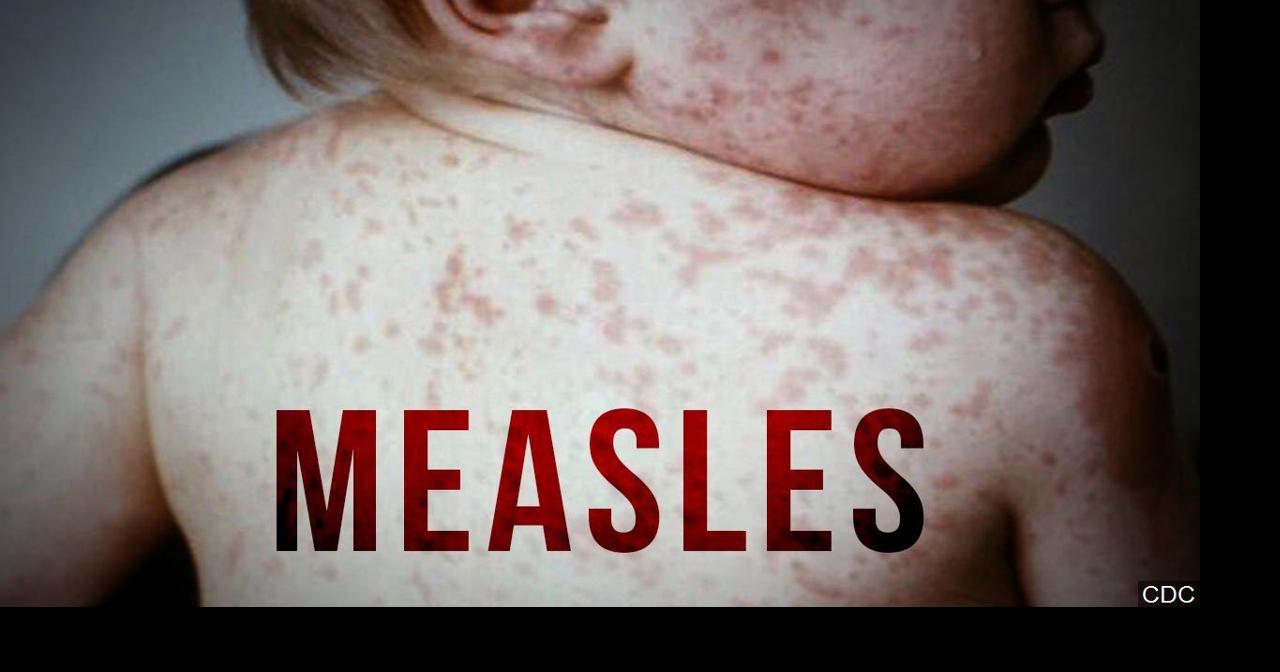 Colorado's measles outbreak is over, and the weekly US case count ...