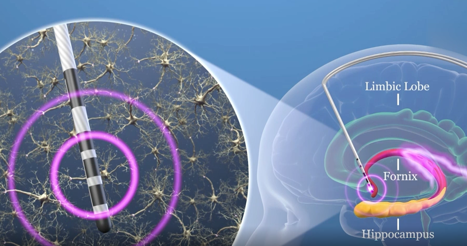 Deep brain stimulation technology could improve dozens of conditions ...