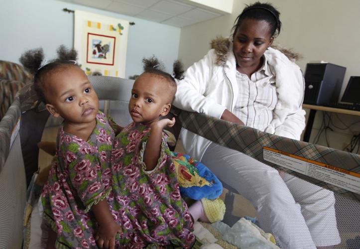 conjoined twins separated