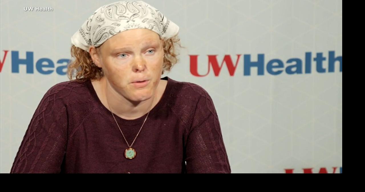 Burn survivor helping other injured youth with burns | Video | wxow.com