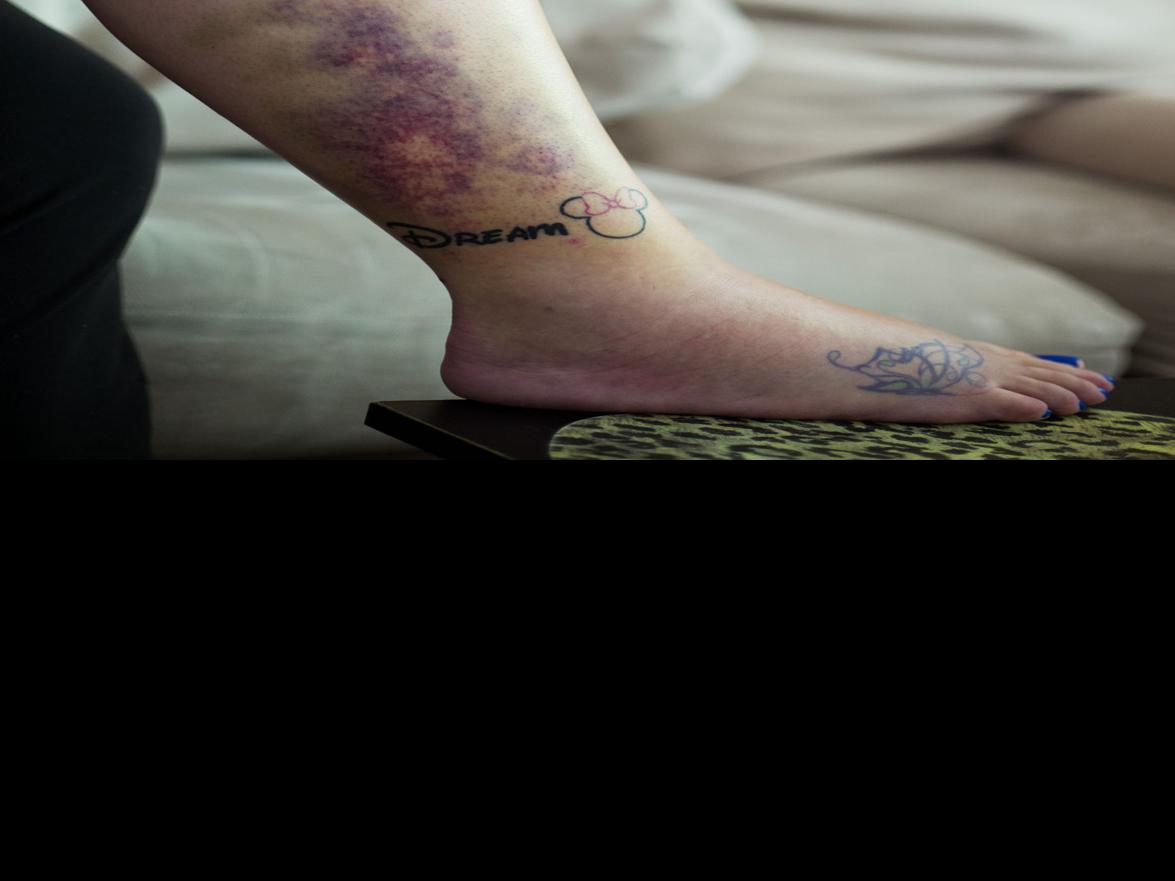 worst rattlesnake bite