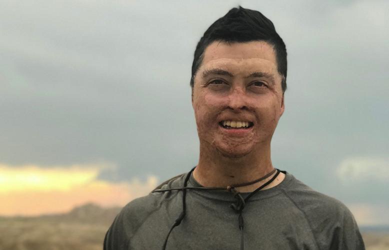 Firefighter grievously injured in Washington wildfire faces uphill ...