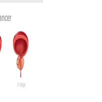 Managing Advanced Prostate Cancer | | yesweekly.com