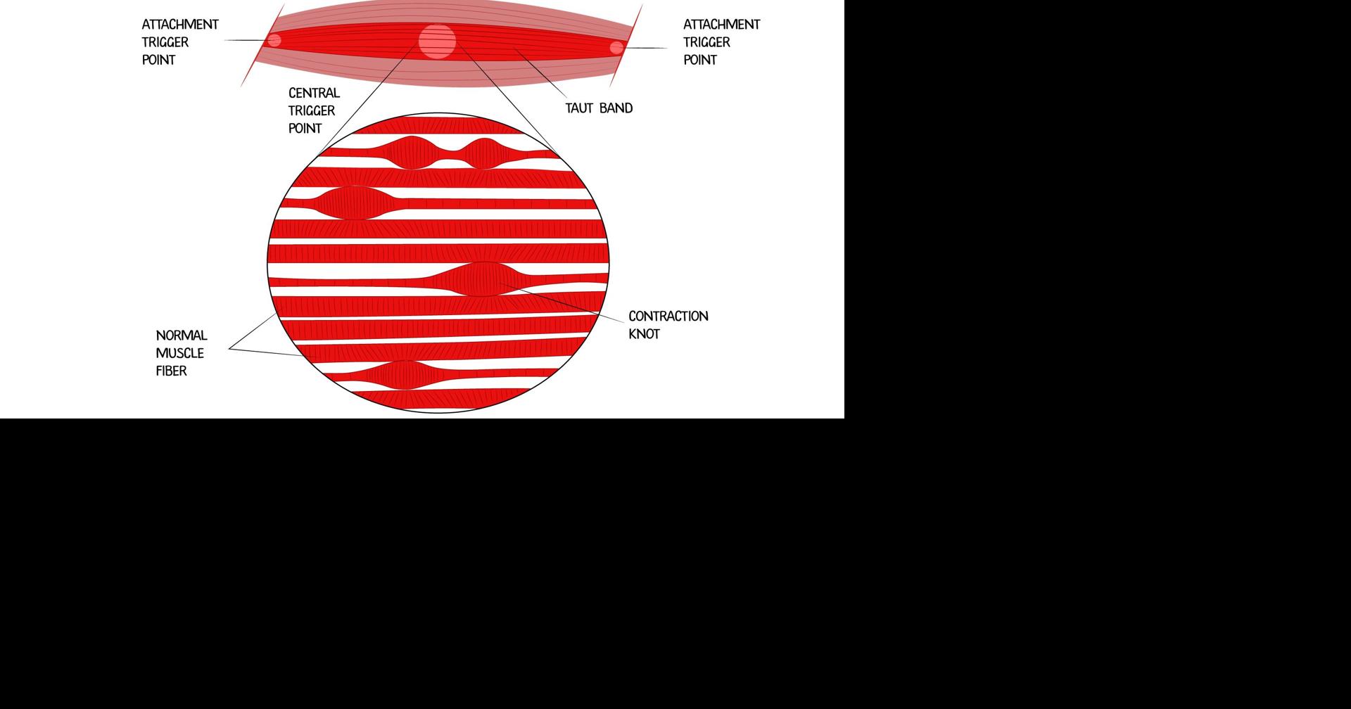 The,Structure,Of,The,Trigger,Point,In,The,Muscle.,Attachment ...