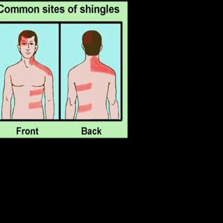 Risk of shingles increases with age | Newsarchives | yoursun.com