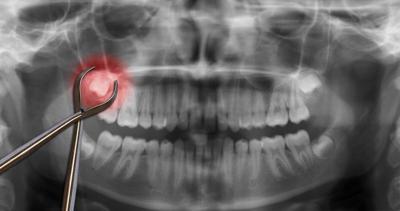 Why are all four wisdom teeth removed? | Feeling Fit | yoursun.com