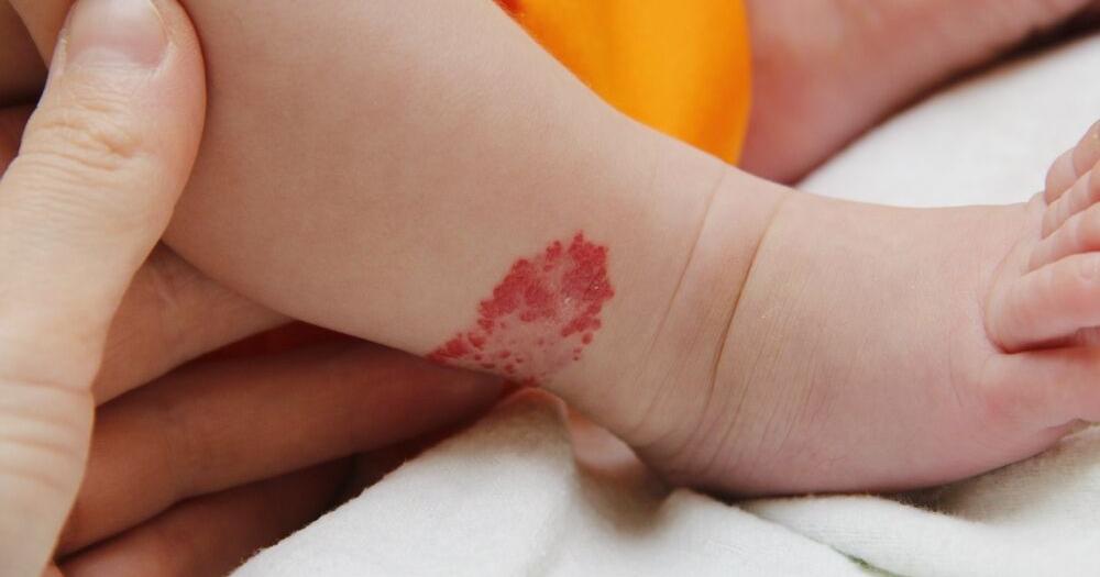 What is this bright red birthmark on my baby? | Feeling Fit | yoursun.com