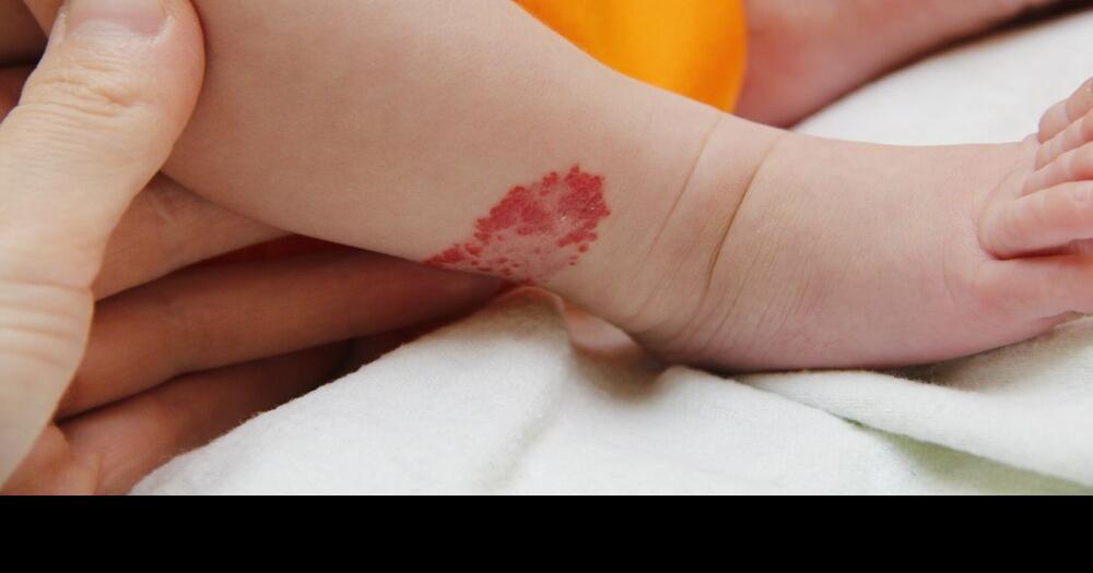 What is this bright red birthmark on my baby? | Feeling Fit | yoursun.com