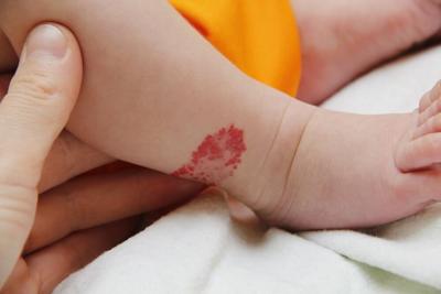 What is this bright red birthmark on my baby? | Feeling Fit | yoursun.com