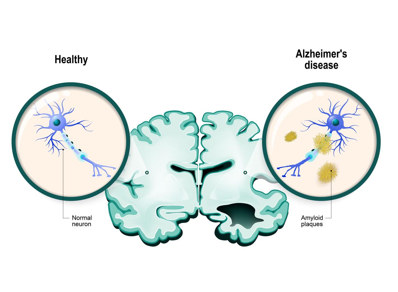 10 early signs of Alzheimer's disease | Feeling Fit | yoursun.com